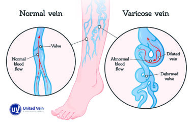 What Causes Swollen Veins? | UVVC
