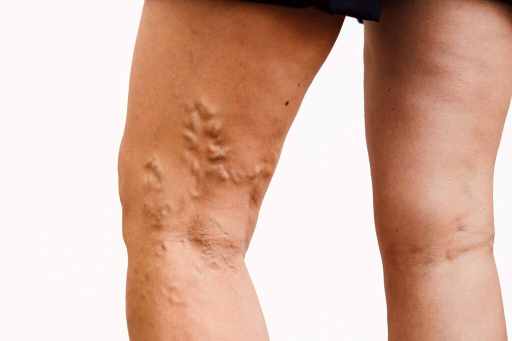 Vein Conditions & Treatments | United Vein & Vascular Centers®