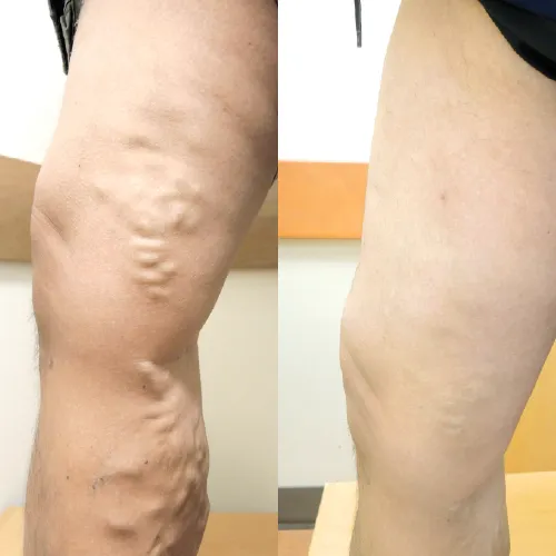 Vein Clinic in Gilbert, AZ | United Vein & Vascular Centers®