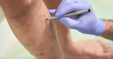 Is Microphlebectomy Right for You? Benefits, Recovery & More