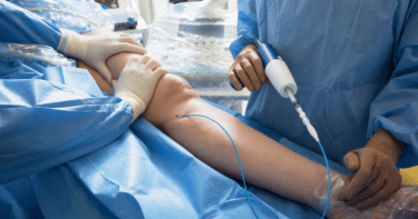 VenaSeal Closure System: A Minimally Invasive Vein Treatment