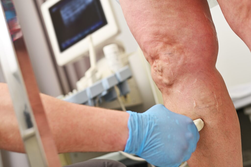Phlebitis Symptoms, Causes, and Treatments | United Vein & Vascular ...
